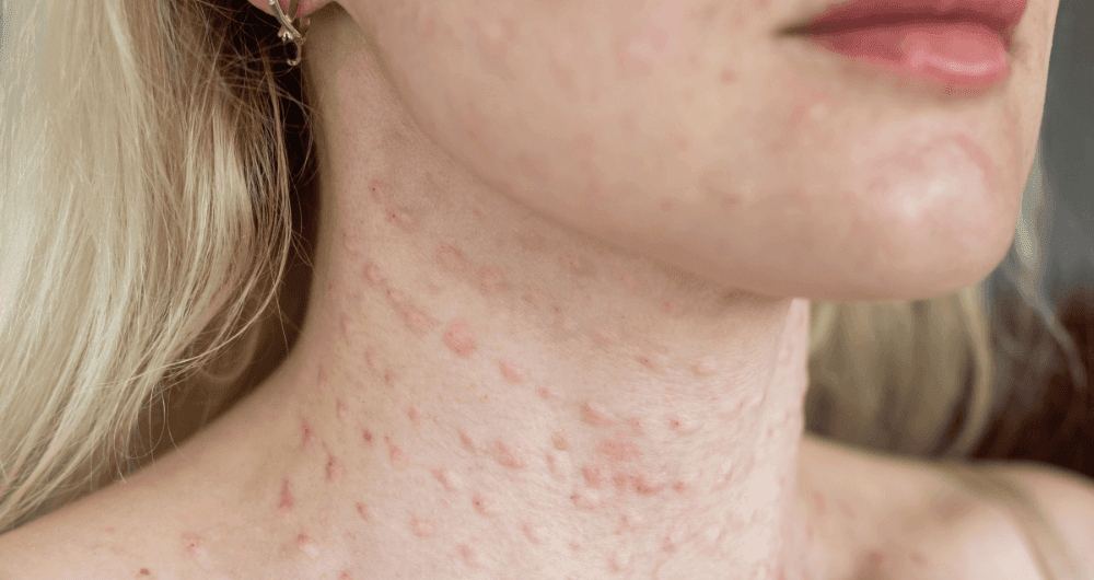 Cancers de la peau : les premiers signes