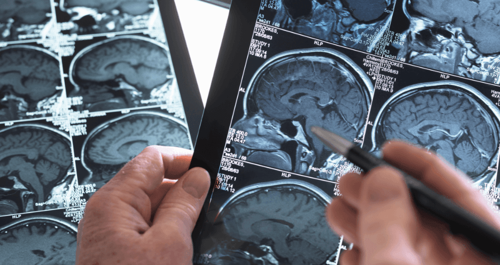 Tout savoir sur le scanner cérébral normal